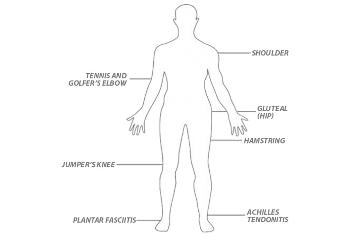 Tenex Health TX System in CA | LA Ortho and Wellness